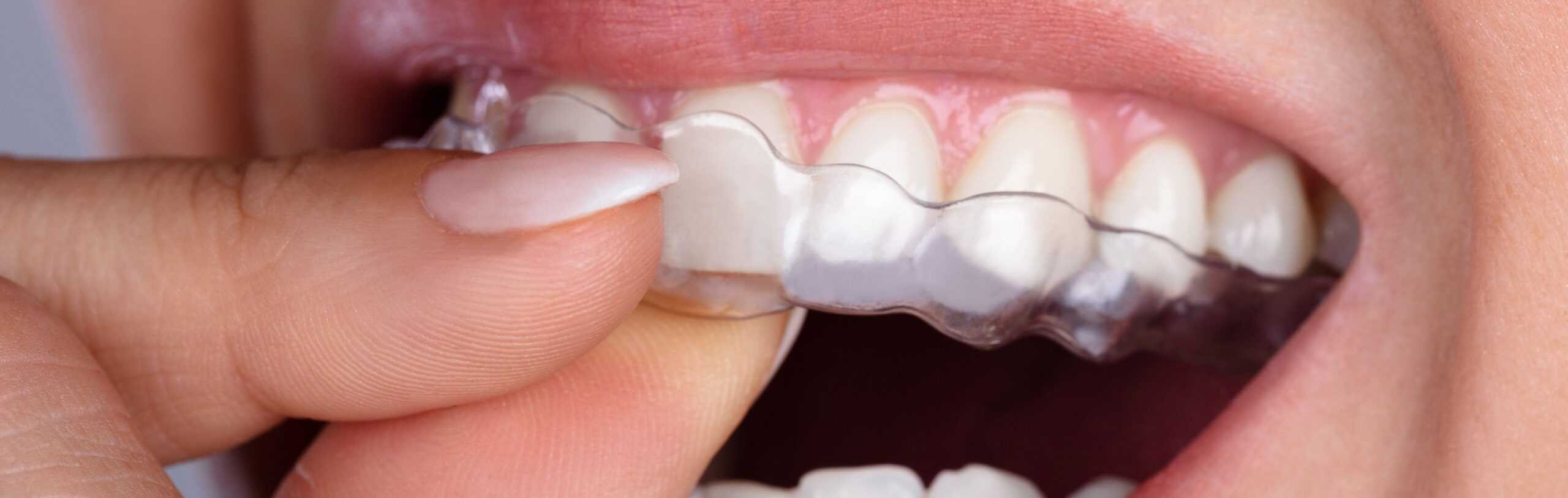 Spark Clear Aligners | Invisible Braces in Castle Rock, CO